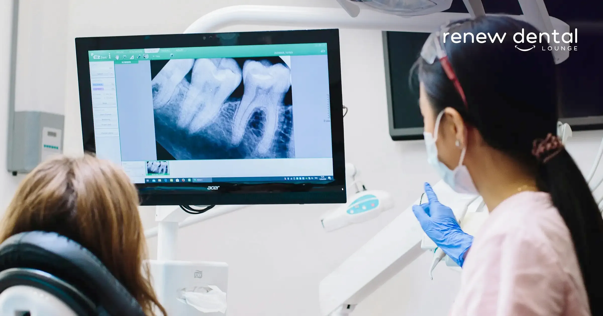Wisdom Tooth Extraction in Upper Mount Gravatt | Renew Dental Lounge